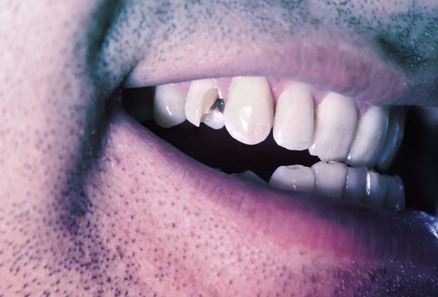 Guidelines for the Management of Traumatic Dental Injuries - Indiana ...